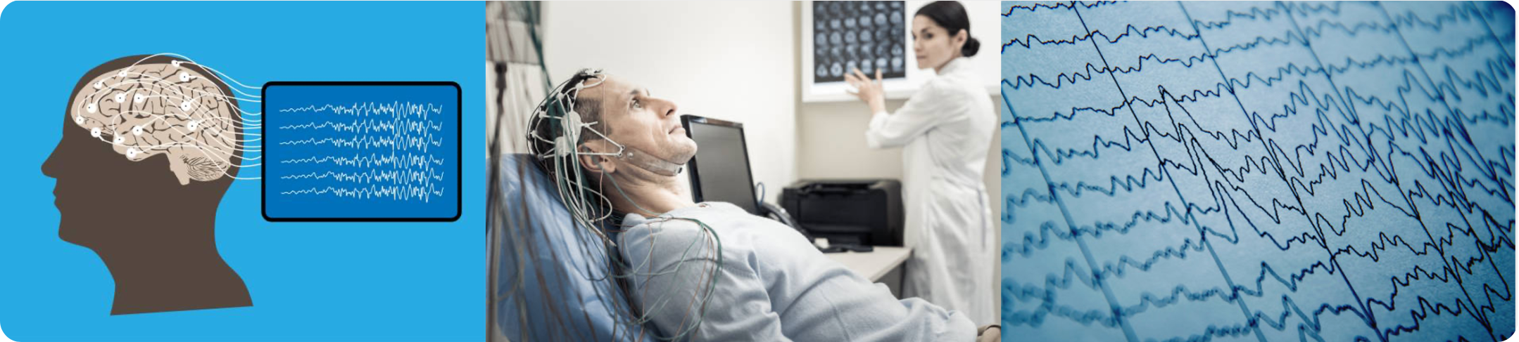 QEEG Brain Mapping – Neuro Path Clinic